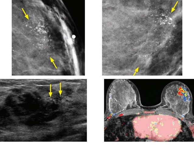 BIRADS, Breast Ultrasound, mamography | PPTX
