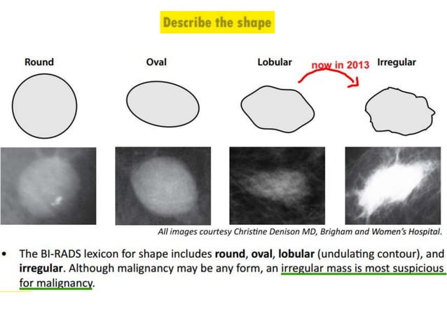 BIRADS, Breast Ultrasound, mamography