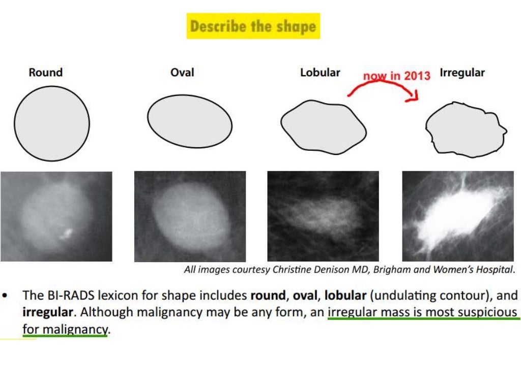 BIRADS, Breast Ultrasound, mamography
