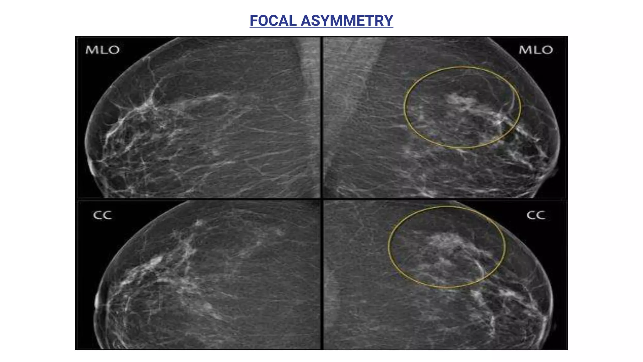 Birads sono-mammography | PPTX
