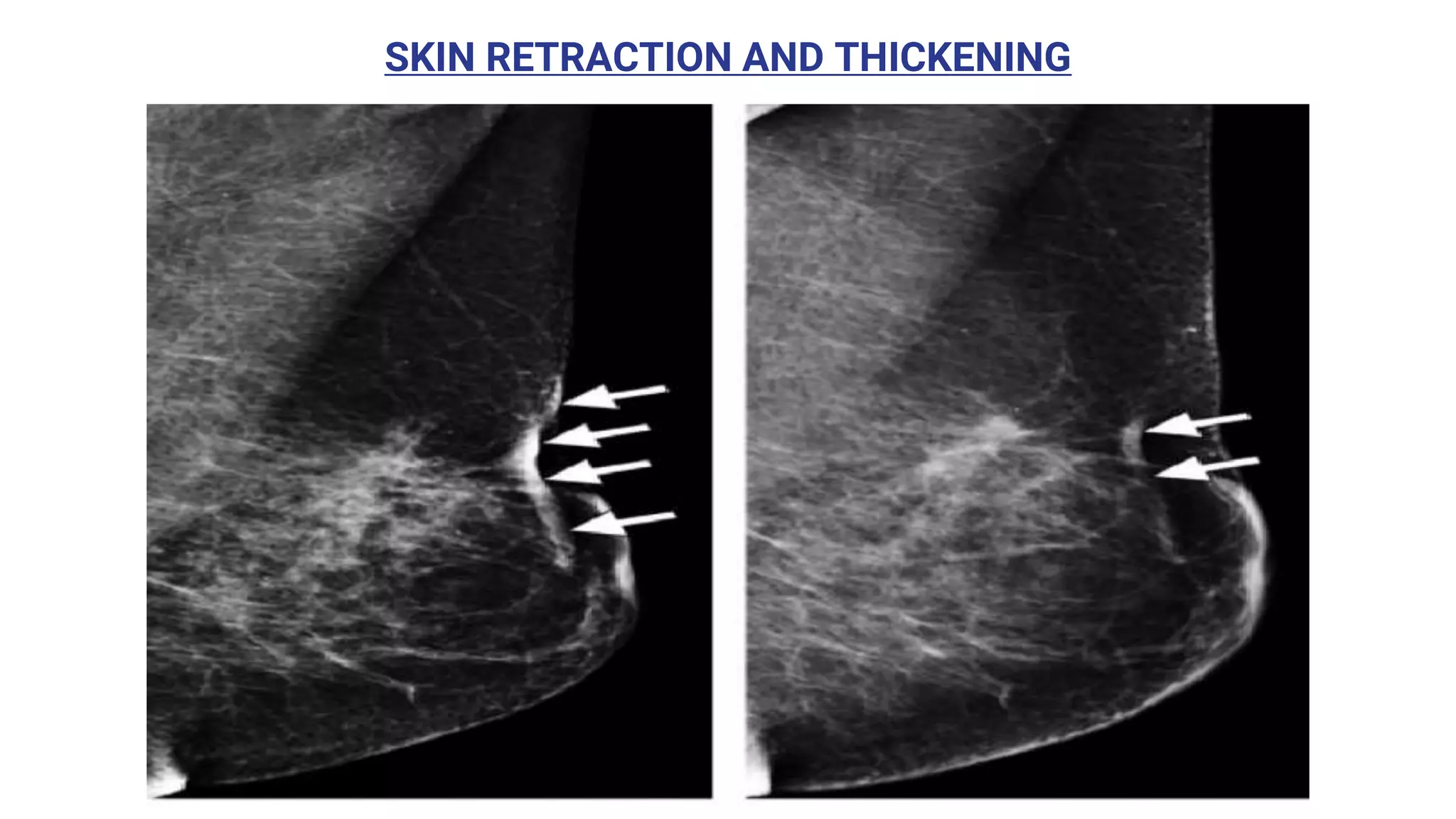 Birads sono-mammography | PPTX