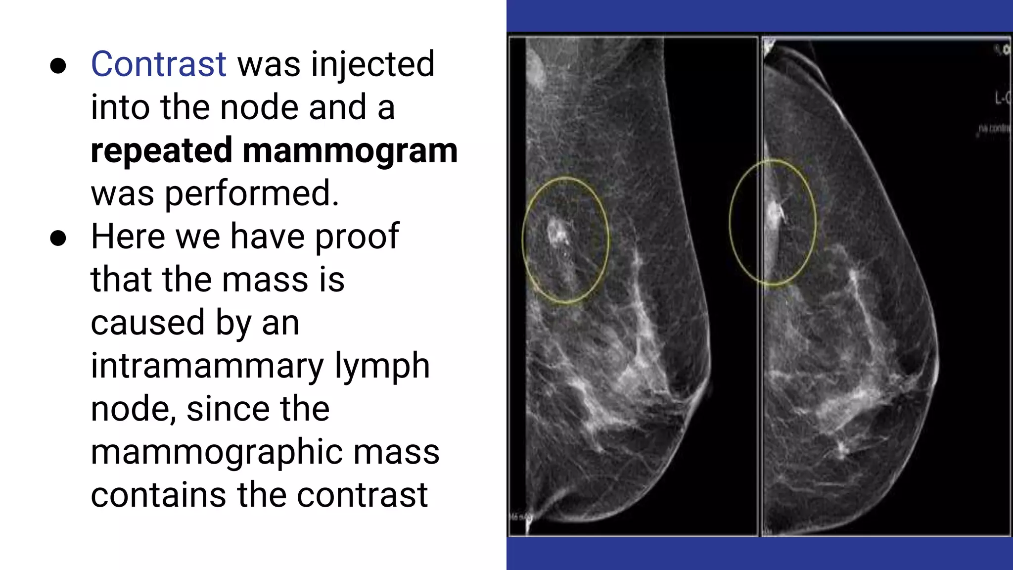 Birads sono-mammography | PPTX