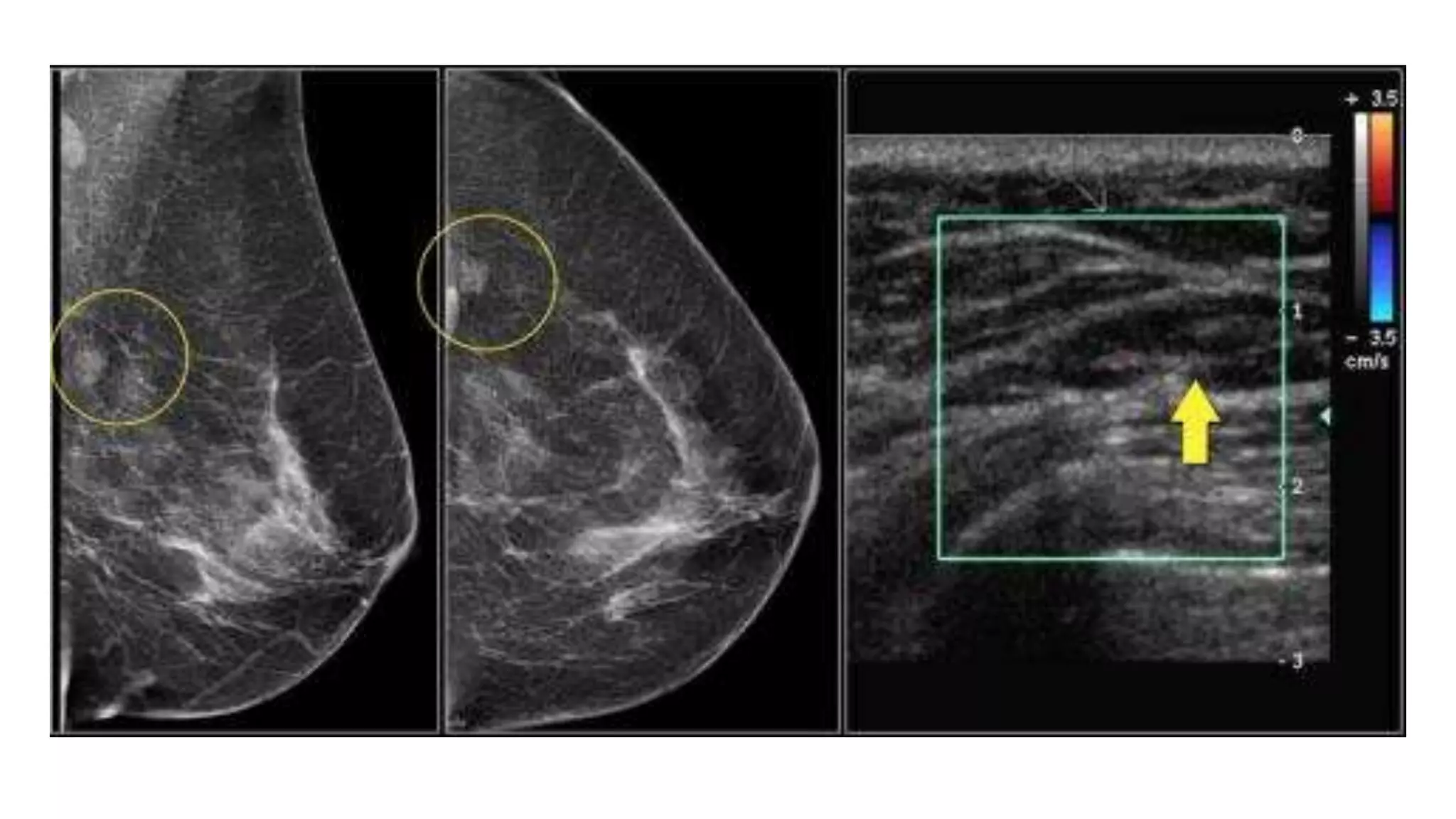 Birads sono-mammography | PPTX
