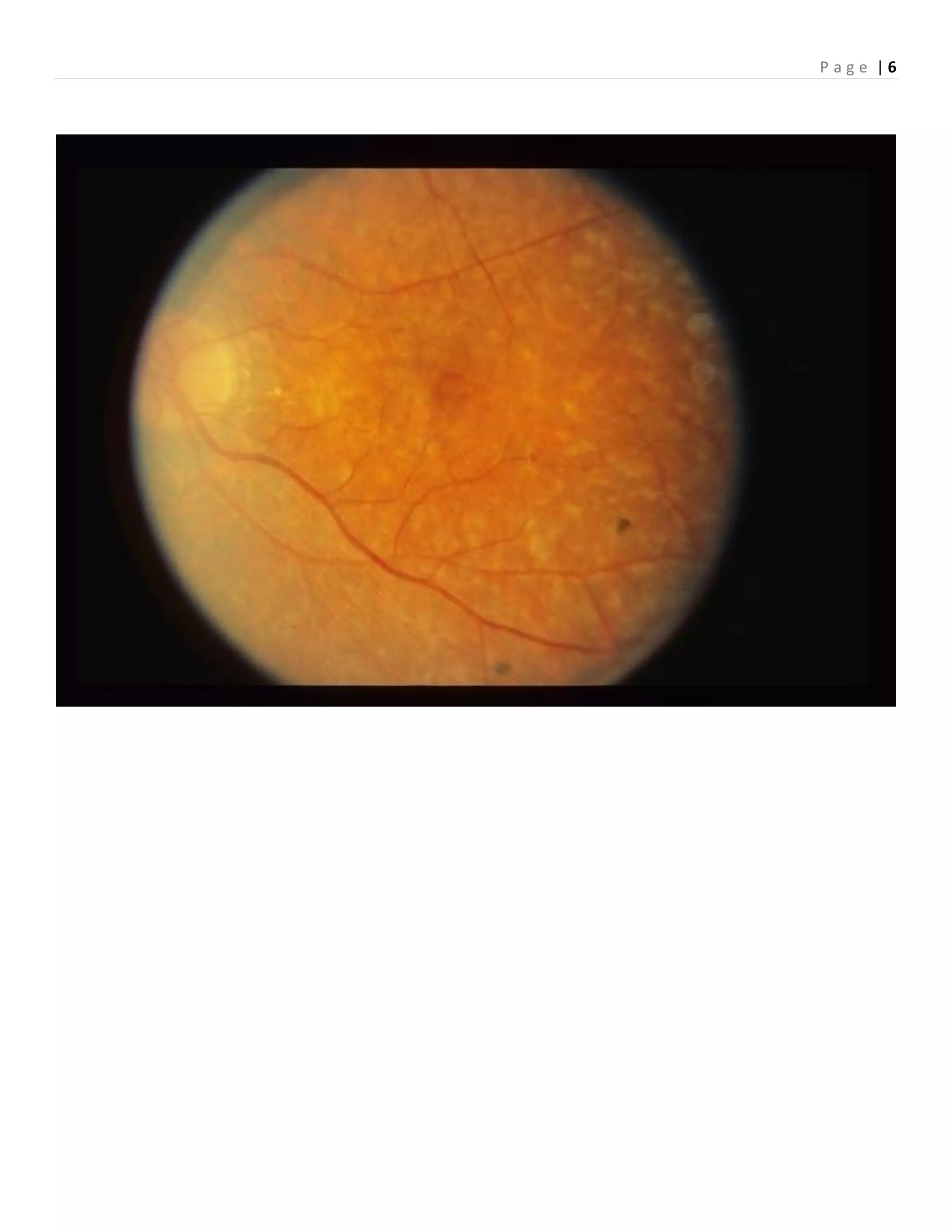 Birdshot uveitis | PDF