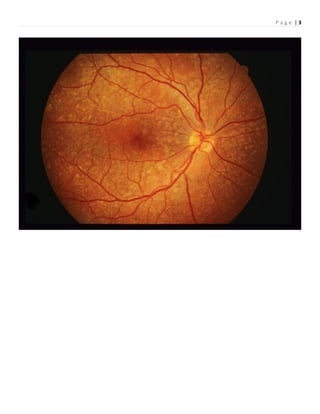 Birdshot uveitis | PDF