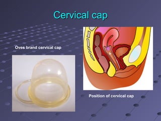 Oves Cervical Caps