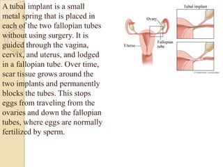 Birth control methods | PPTX