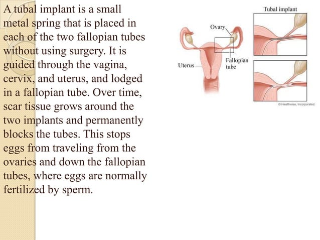Birth control methods | PDF