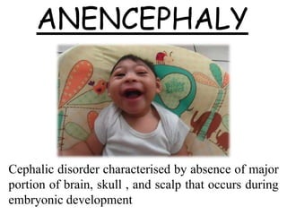 Birth defects | PPTX