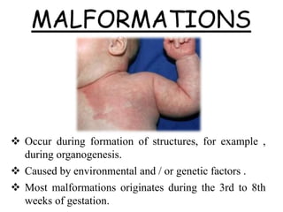 Birth defects | PPTX
