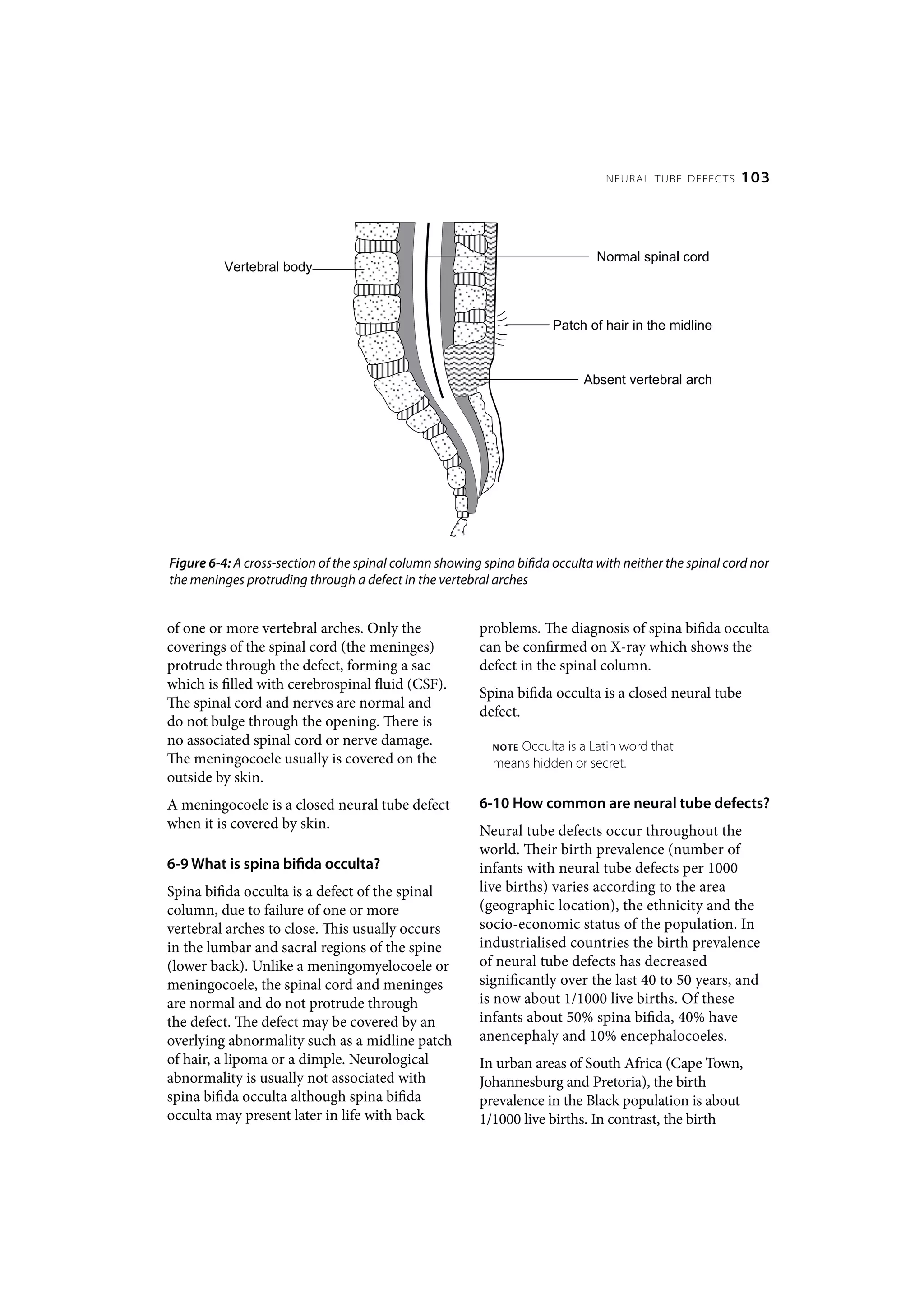 Birth Defects: Neural tube defects | PDF