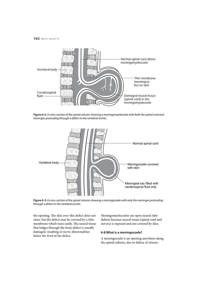 Birth Defects: Neural tube defects | PDF