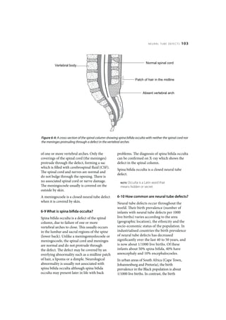 Birth Defects: Neural tube defects | PDF
