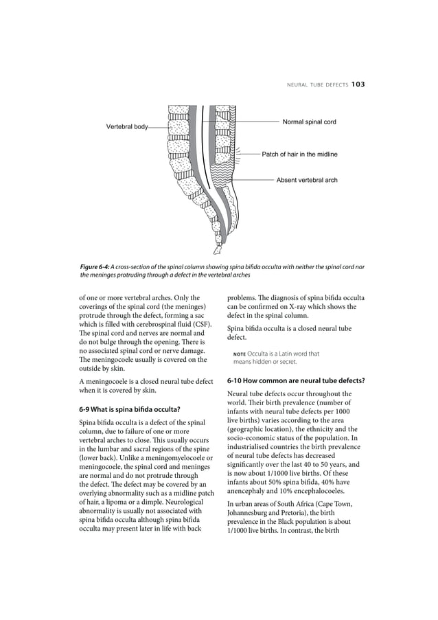 Birth Defects: Neural tube defects | PDF