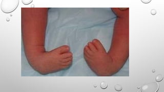 BIRTH DEFECTS OF LIMBS by Dr. Rabia Inam Gandapore.pptx