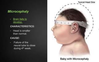Birth Defects | PPTX