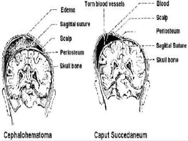 CEPHALOHEMATOMA VS SUBGALEAL HEMATOMA RADIOLOGY - Wroc?awski Informator ...