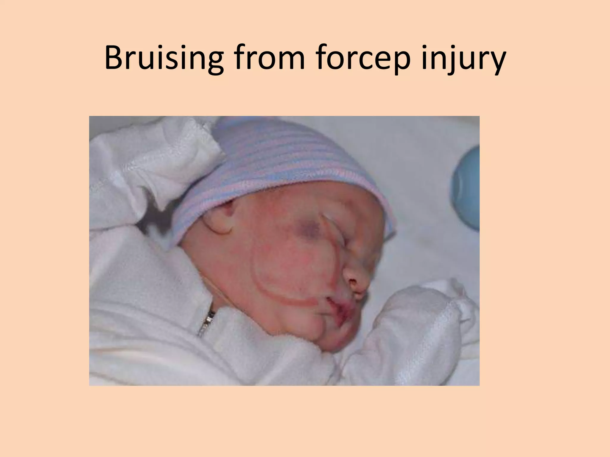 Birth injuries | PPTX