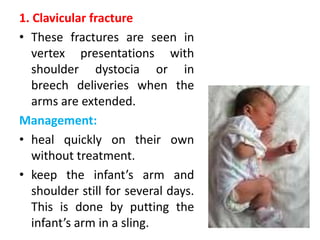 Clavicle Fracture Newborn