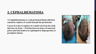 Birth injuries.P | PPT