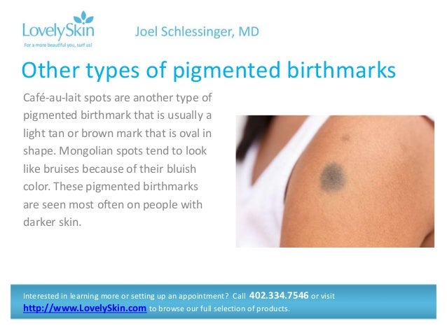 Joel Schlessinger MD FAQ - Birthmarks