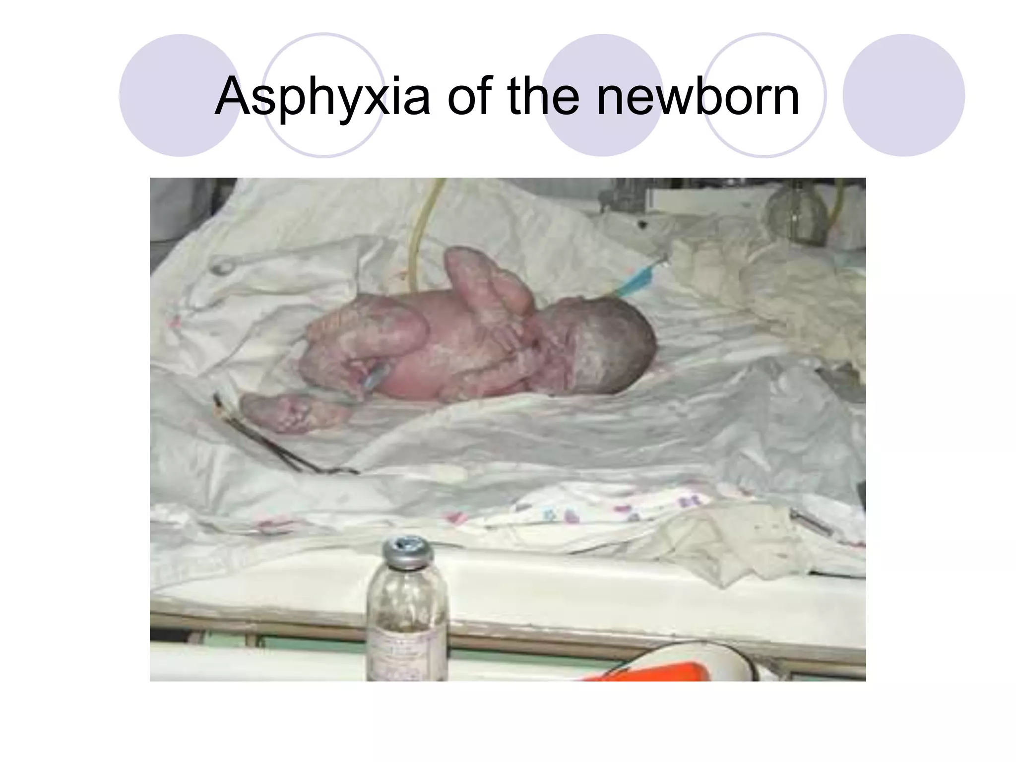 Birth Trauma. Asphyxia.ppt