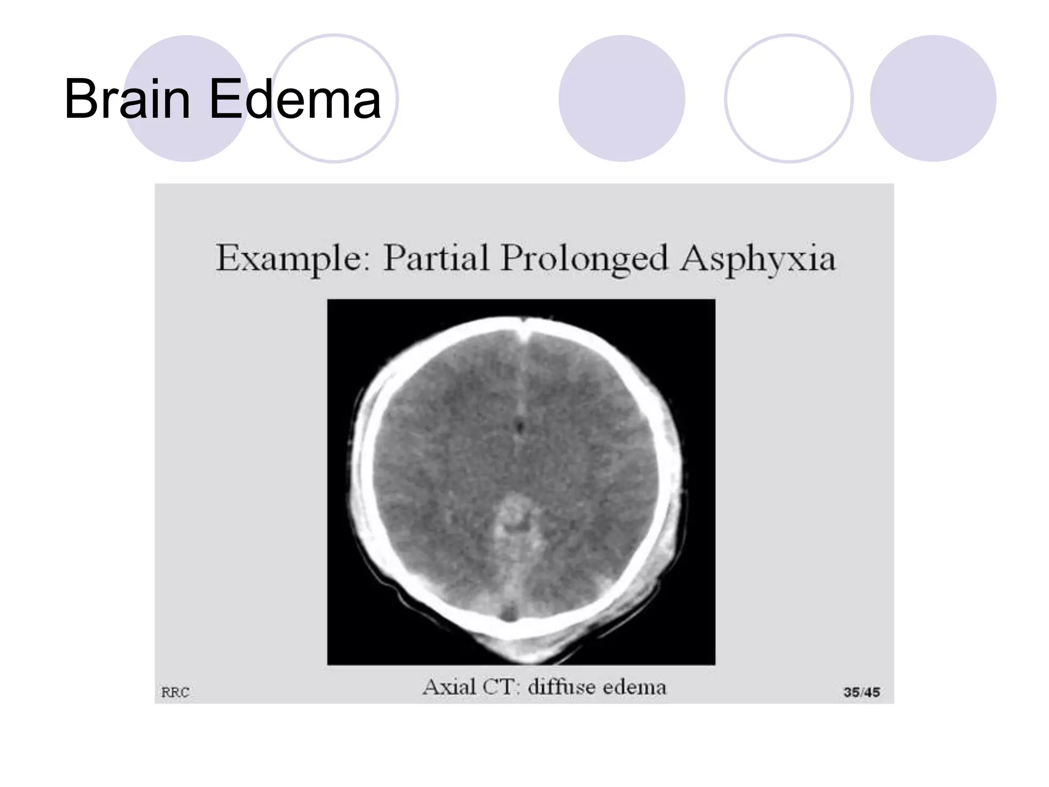 Birth Trauma. Asphyxia.ppt