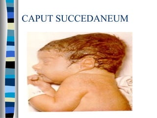 Birth trauma 2010 | PPT