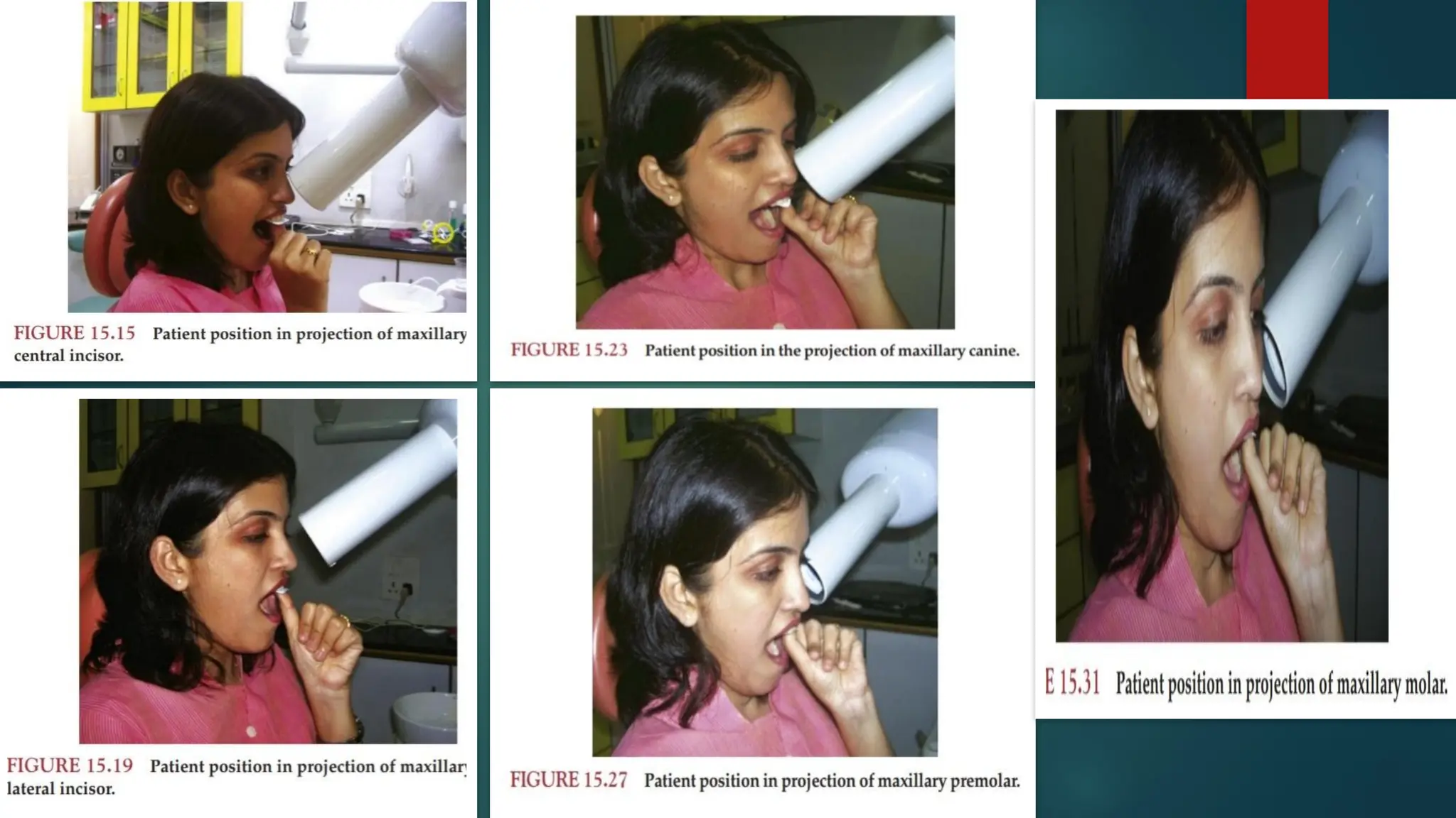 Bisecting Angle Technique Radiology PPT | PPTX