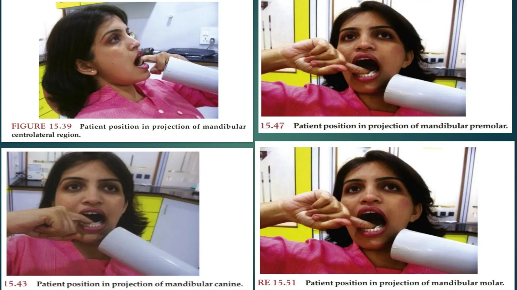 Bisecting Angle Technique Radiology PPT | PPTX