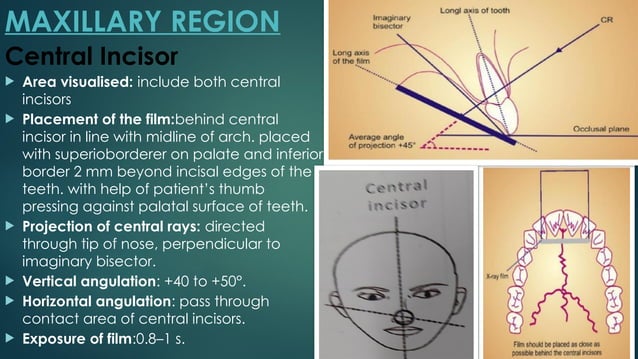 Bisecting Angle Technique Radiology PPT | PPTX