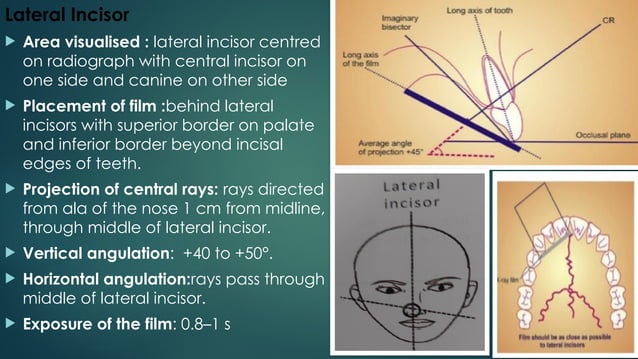 Bisecting Angle Technique Radiology PPT | PPTX