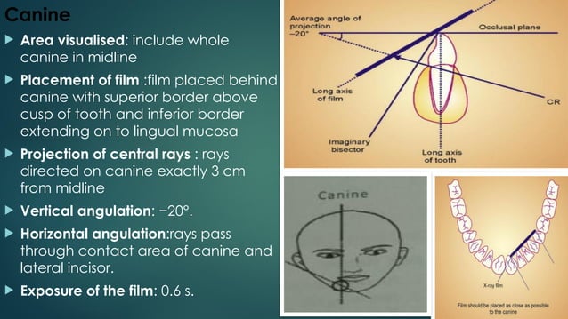 Bisecting Angle Technique Radiology Ppt Pptx