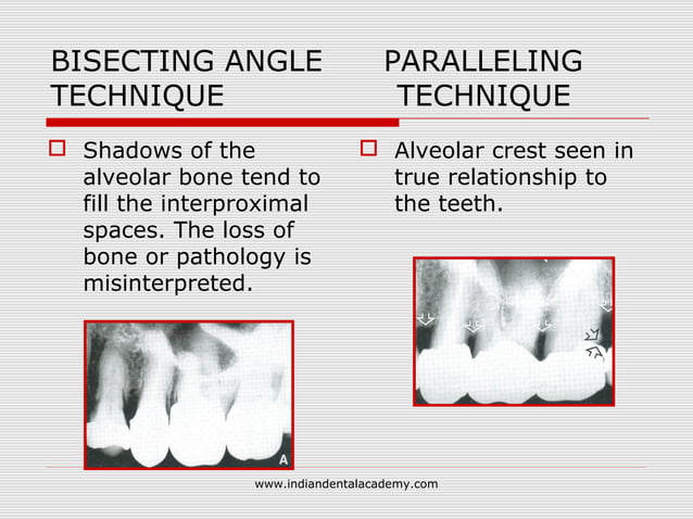 Bisecting angle vs paralleling technique /orthodontic courses by Indian ...