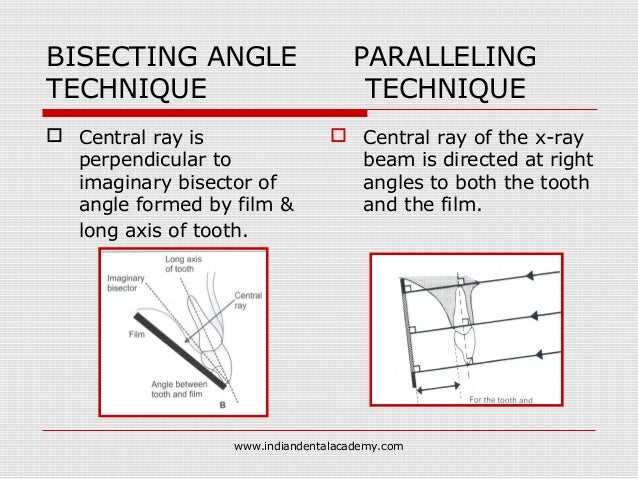 Bisecting angle vs paralleling technique /orthodontic courses by Indi…