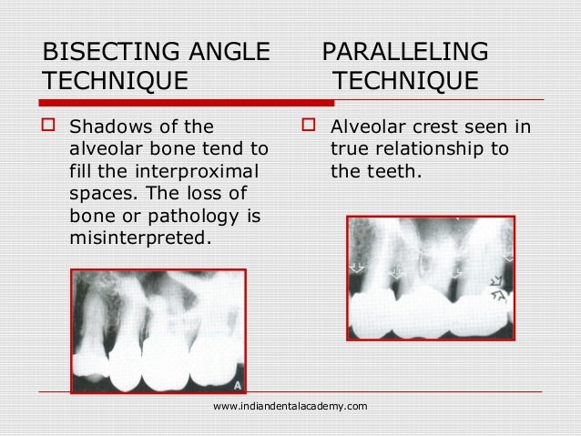 Bisecting angle vs paralleling technique /orthodontic courses by Indi…