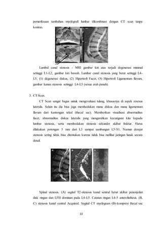 referat neuro stenosis lumbal | DOCX