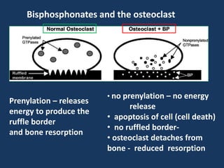 Bisphosphonate lecture lahore malcolm harris | PPTX
