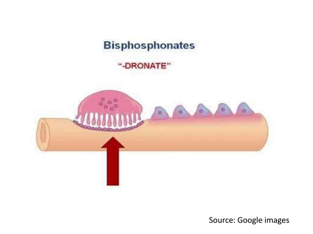 Bisphosphonates in Osteoporosis.pptx | Bone and Joint Conditions ...