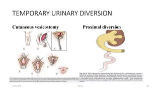 Bisrat Edit Approach to Hydronephrosis in children.pptx