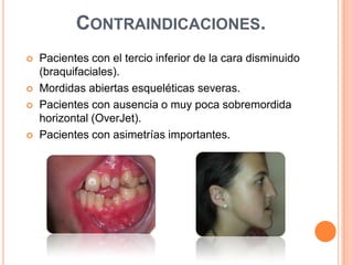 Tratamiento de las maloclusiones con patrón facial hiperdivergente ...