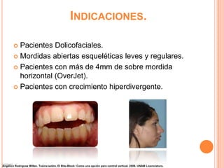 Tratamiento de las maloclusiones con patrón facial hiperdivergente ...