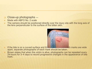 Bite mark | PPTX