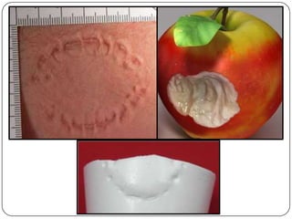 Bite mark impression | PPTX
