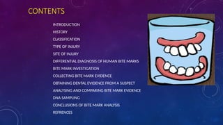 Bite marks in forensic odontology- OMandOR | PPTX