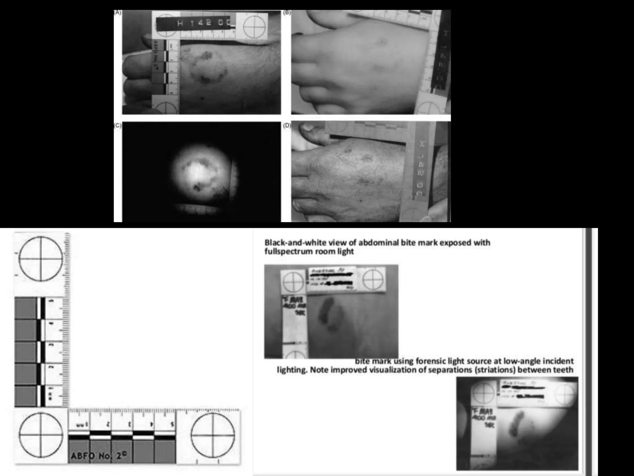 Bite Marks (FORENSIC DENTISTRY) | PPTX