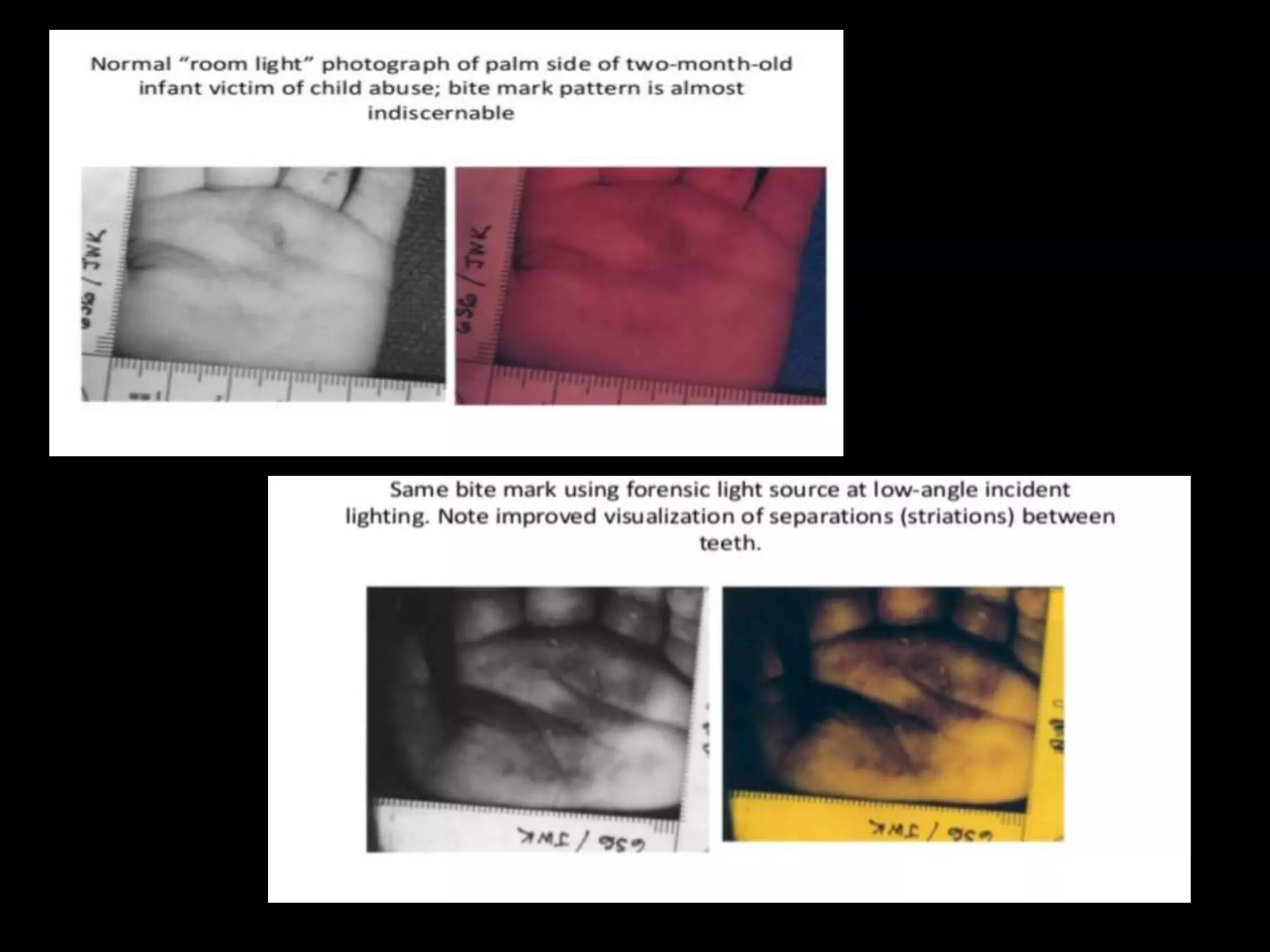 Bite Marks (FORENSIC DENTISTRY) | PPTX