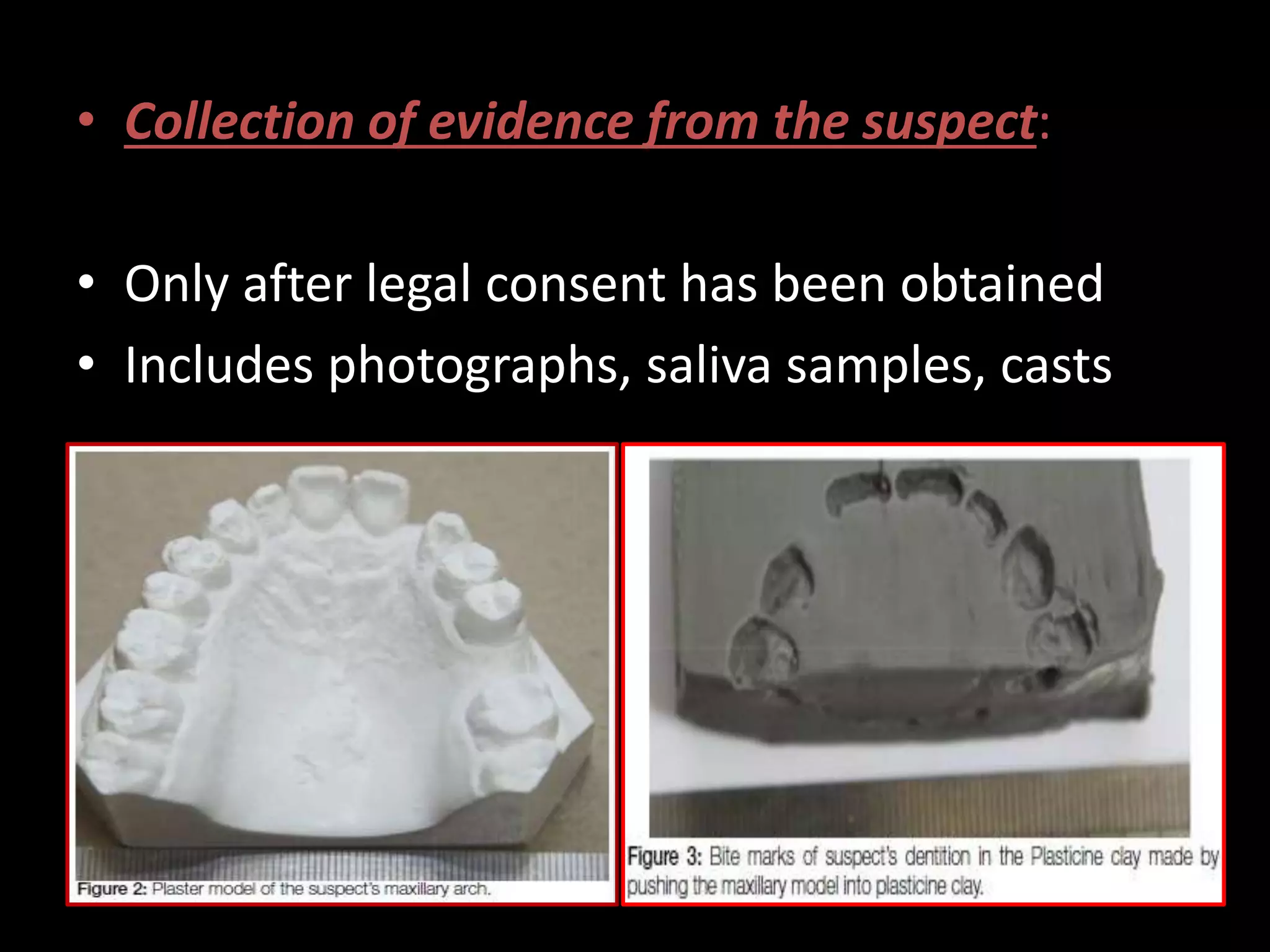 Bite Marks (FORENSIC DENTISTRY) | PPTX