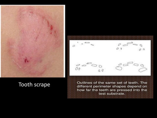 Bite Marks Forensic Dentistry Pptx