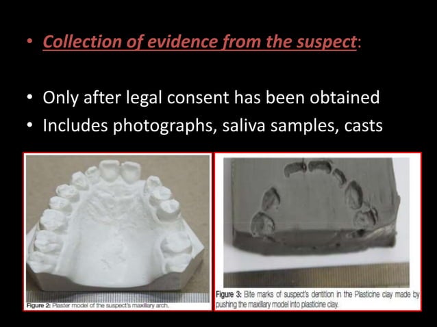 Bite Marks (FORENSIC DENTISTRY) | PPTX